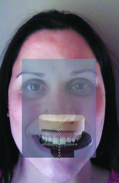 Dental News - The Virtual Facebow: A digital companion to implantology