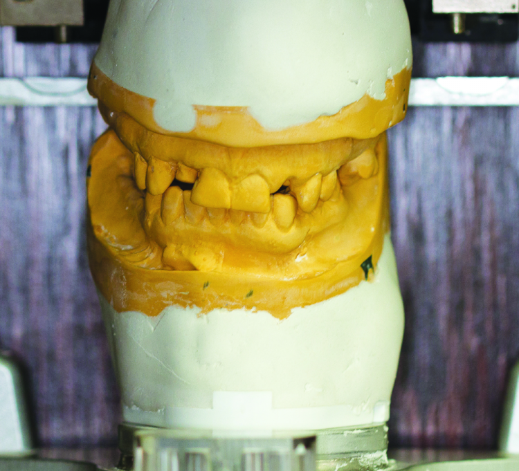 Dental News - The Virtual Facebow: A digital companion to implantology