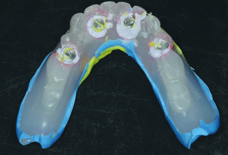 Dental News - Treatment options for the edentulous arch