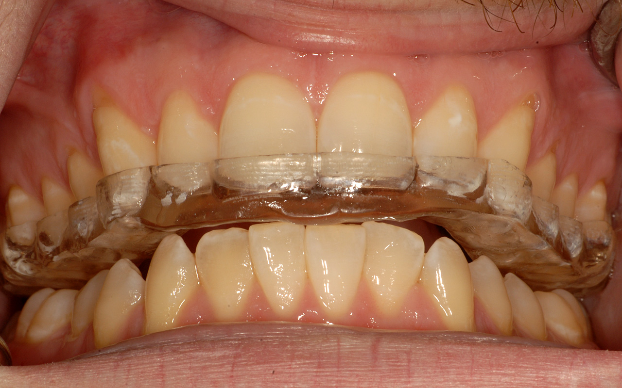 Dental News - Occlusion principles for the practising dentist in the ...