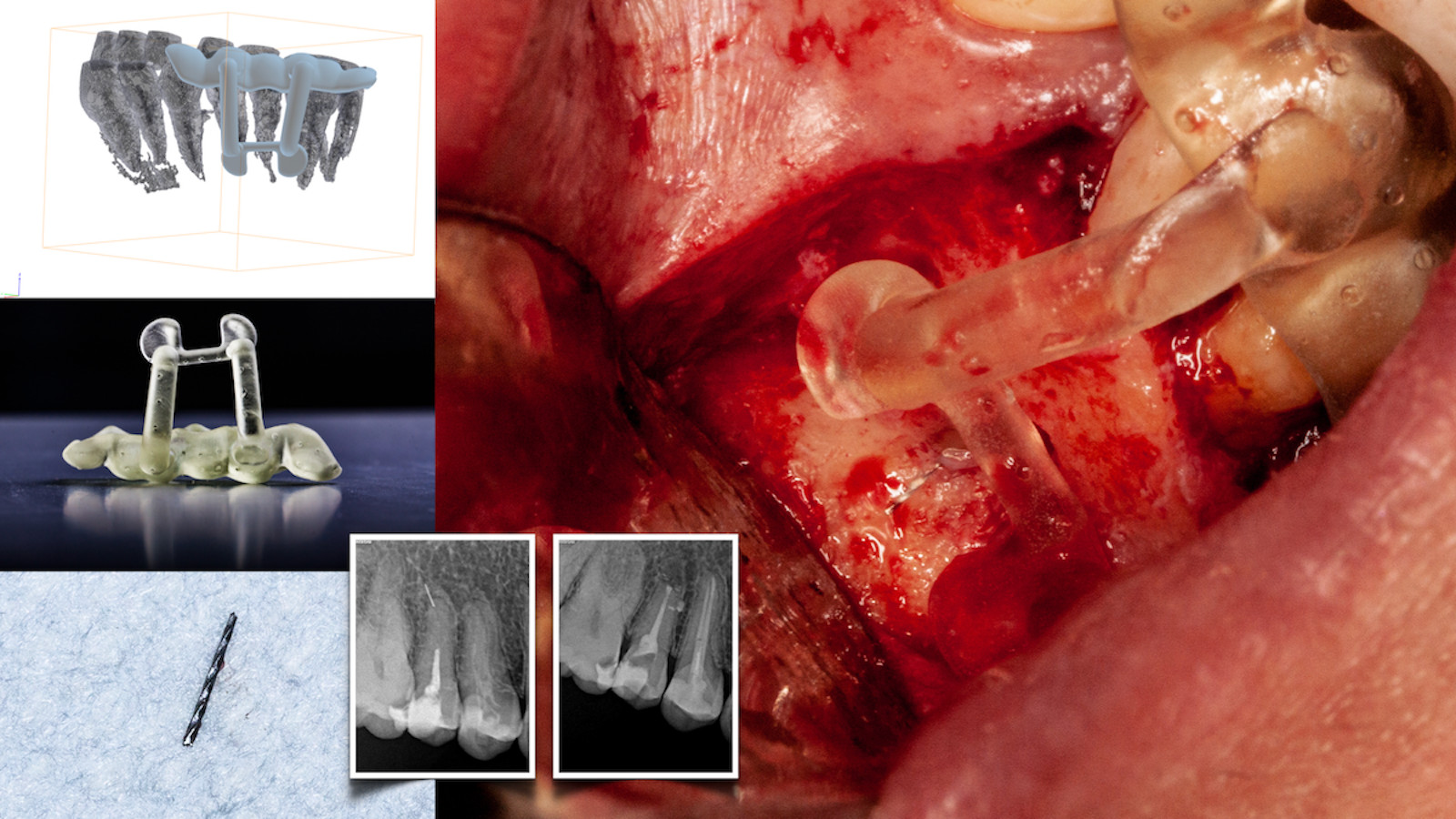 Dental News - Dynamic navigation—The future of minimally invasive ...