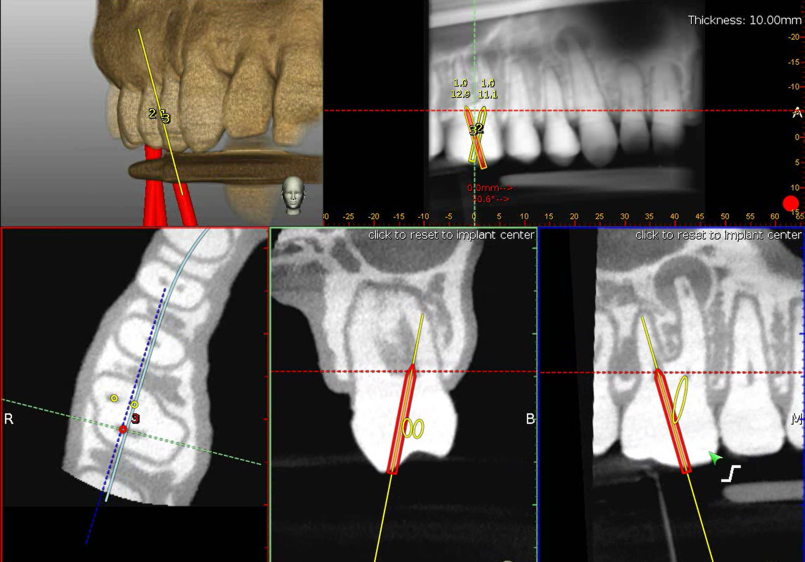 Dental News - Dynamic navigation—The future of minimally invasive ...