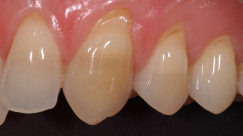 Dental News - Dentine hypersensitivity experience using toothpaste with ...