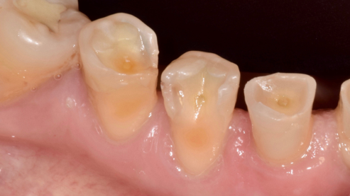 Dental News - Dentine hypersensitivity experience using toothpaste with ...