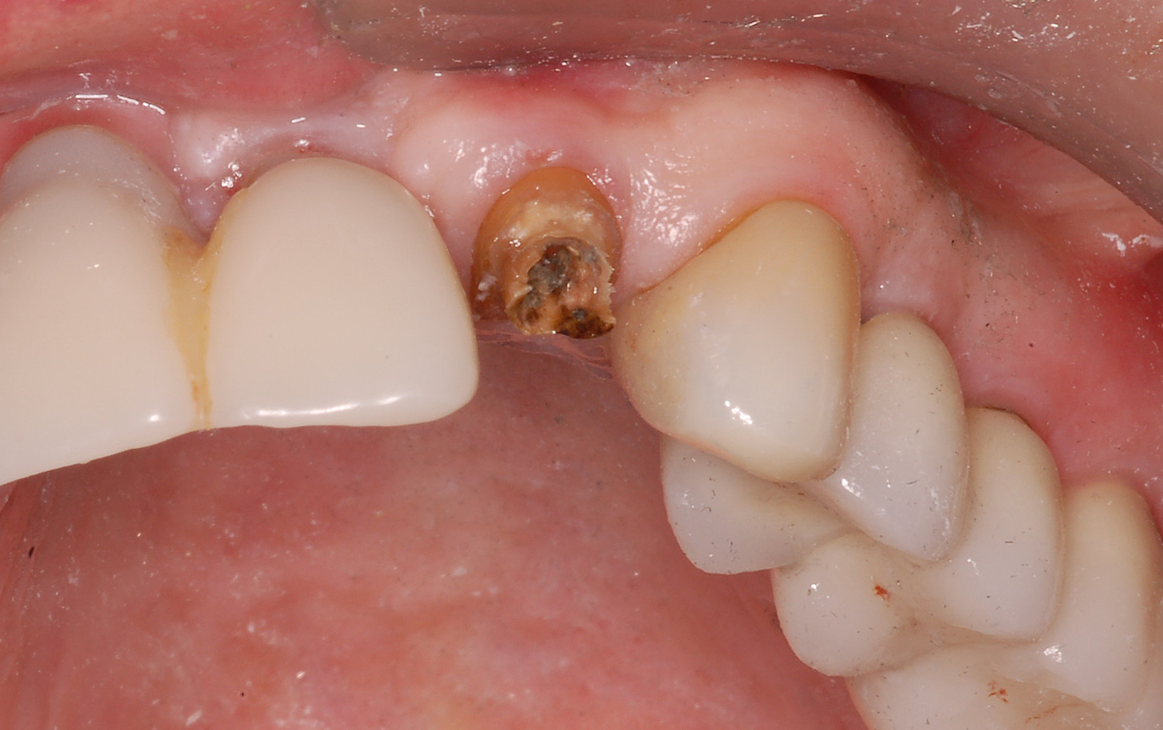 Dental News - Guided applications for partial extraction therapy