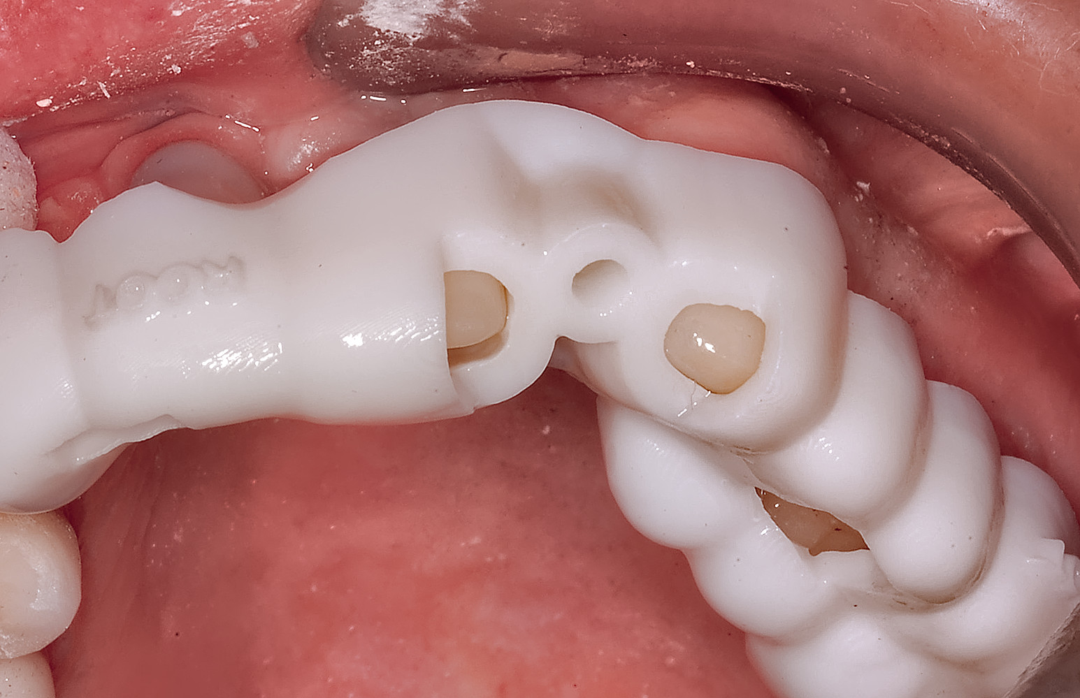 Dental News - Guided applications for partial extraction therapy