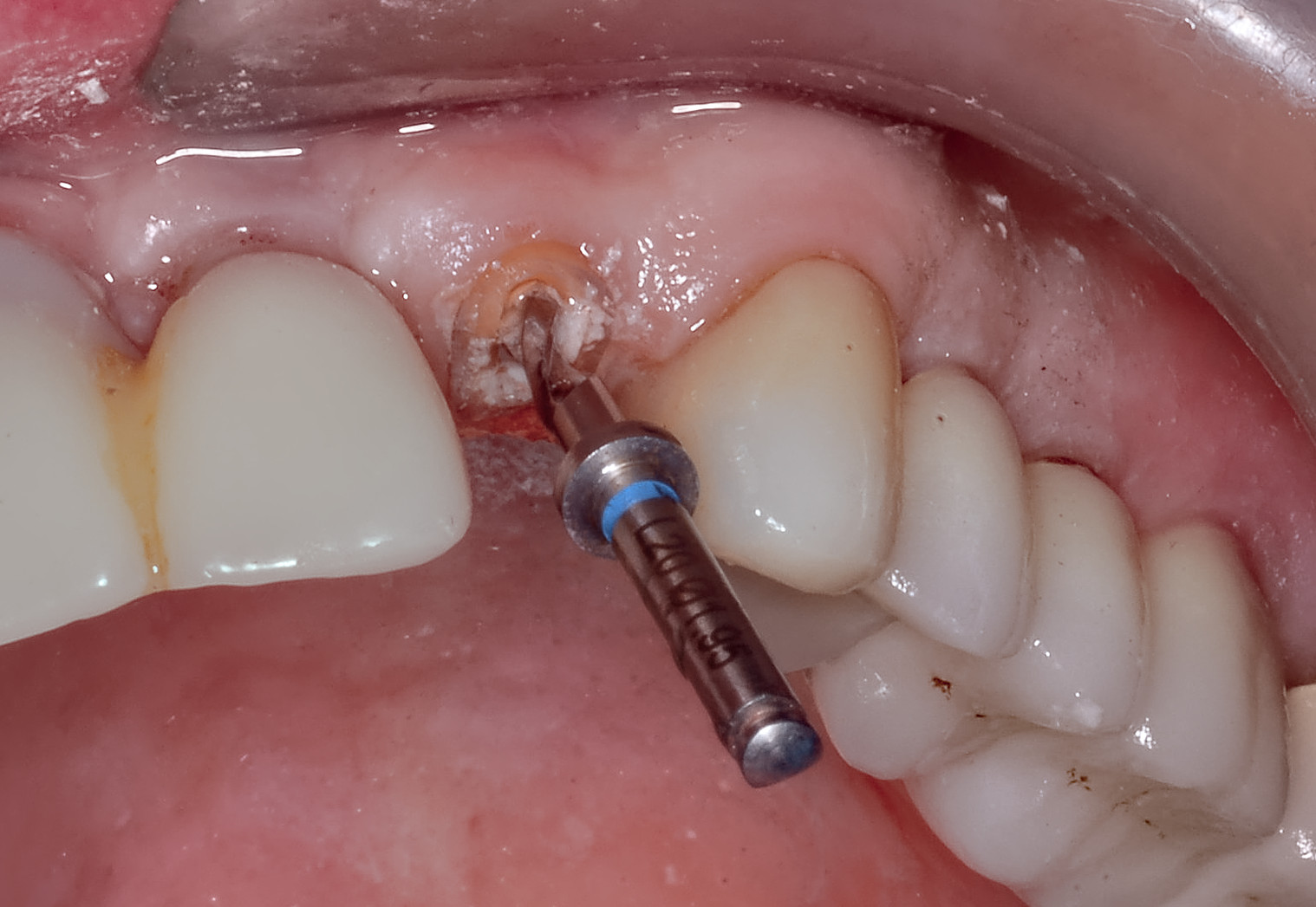 Dental News - Guided applications for partial extraction therapy