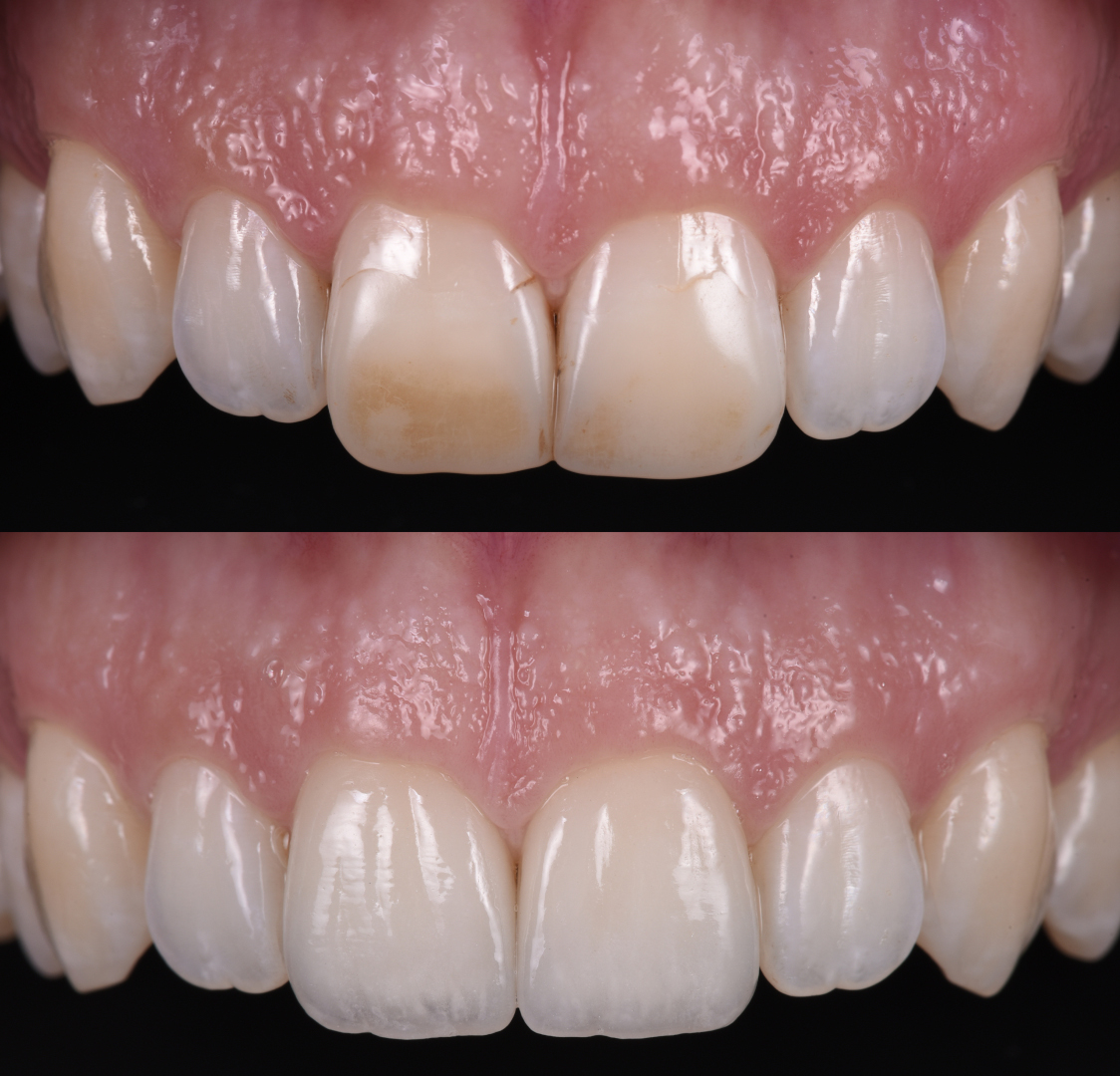 Surface texture: Using horizontal and vertical lines to simulate ...